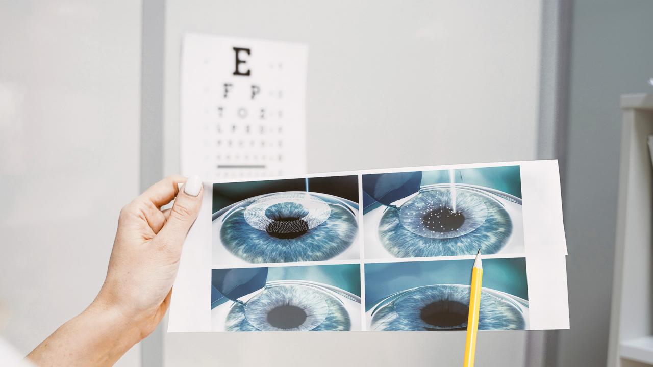 LASIK